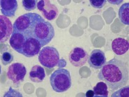 four-nucleate-plasma-cell-in-multiple-myeloma-1