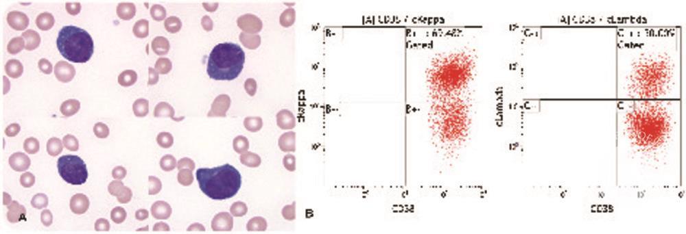 Circulating reactive plasma cells in the setting of peripheral T-cell ... Circulating reactive plasma cells in the setting of peripheral T-cell ...
