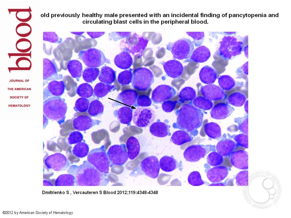 Auer rods in mature granulocytes of a patient with mixed lineage leukemia Auer rods in mature granulocytes of a patient with mixed lineage leukemia