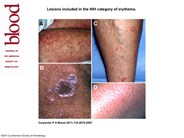 Lesions included in the NIH category of erythema