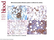 BM intrasinusoidal infiltration pattern in different splenic lymphoma ...