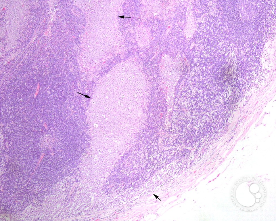 Diffuse Large B-cell Lymphoma, Anaplastic Variant - 2. Diffuse Large B-cell Lymphoma, Anaplastic Variant - 2.