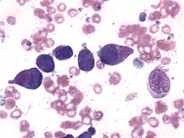 Microgranular variant of acute promyelocytic leukemia with cytoplasmic ...