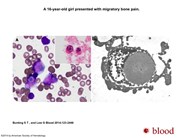 “Russell-like” bodies in Philadelphia chromosome–positive B ...