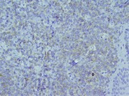 Myeloid Sarcoma, H&E