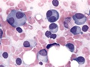 Multiple Myeloma - 3.