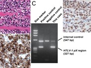 Extensive and destructive invasion of adult T-cell leukemia/lymphoma ...