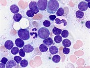 Post-BMT aspirate - 2.