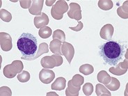 Hairy cell leukemia - 2.