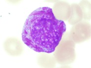 "Faggot" cell in acute promyelocytic leukemia - 1.