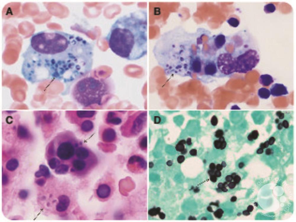 Hemophagocytic lymphohistiocytosis secondary to iatrogenic disseminated ... Hemophagocytic lymphohistiocytosis secondary to iatrogenic disseminated ...
