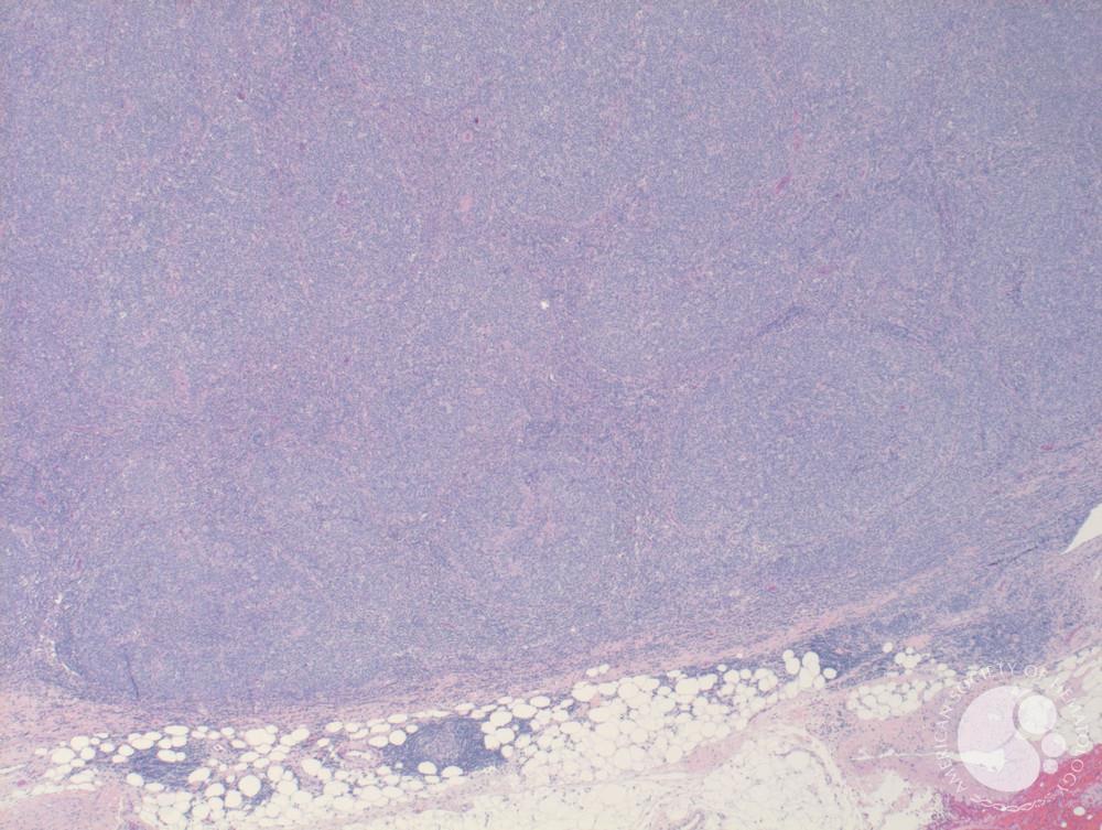 Nodal Follicular Lymphoma-H&E Low Power Nodal Follicular Lymphoma-H&E Low Power