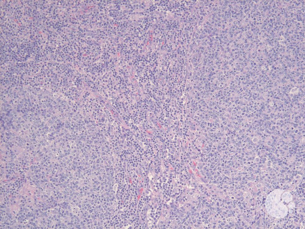 Nodal Follicular Lymphoma-H&E Low Power Nodal Follicular Lymphoma-H&E Low Power