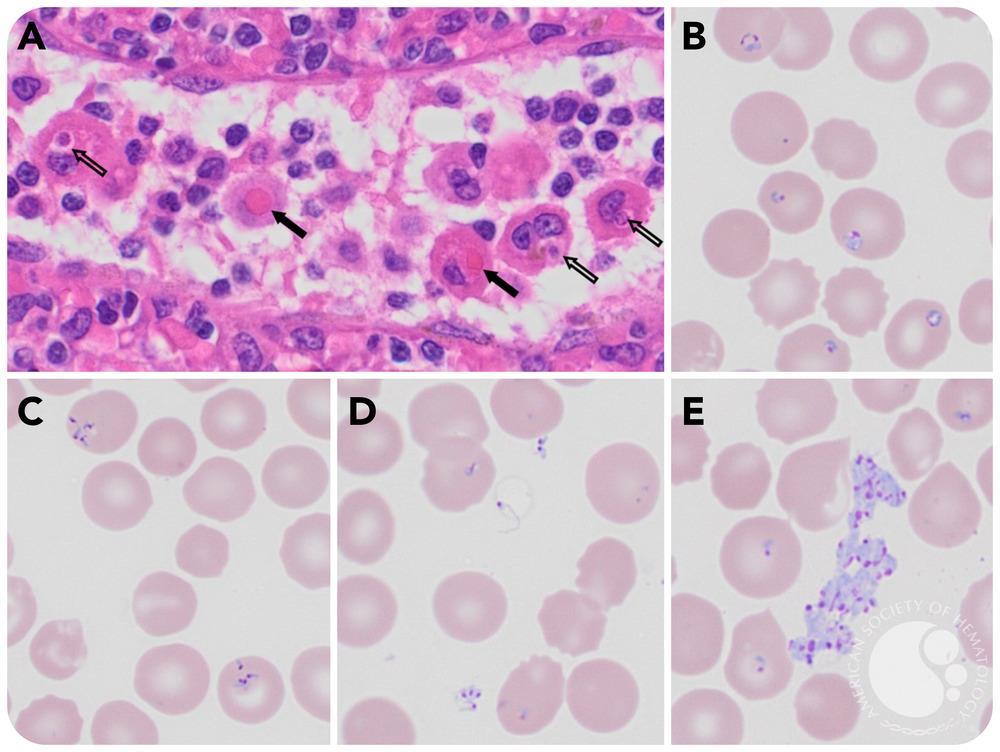 Hemophagocytic lymphohistiocytosis secondary to babesiosis Hemophagocytic lymphohistiocytosis secondary to babesiosis