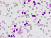 CLL lymphocytes with cytoplasmic inclusions 5