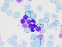 CLL lymphocytes with cytoplasmic inclusions (toluidine blue)