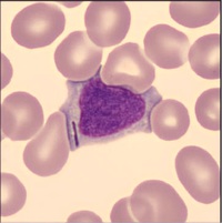 Auer Rod Like Inclusion In Reactive Lymphocyte