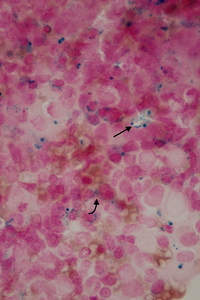 Iron distribution patterns of ACD and MDS