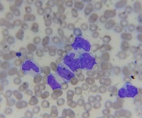 Acute myelomonocytic leukemia