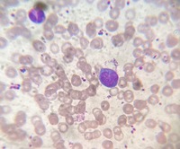 ATYPICAL LYMPHOCYTE IN EBV INFECTION 1