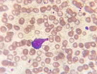 ATYPICAL LYMPHOCYTE IN EBV INFECTION 2
