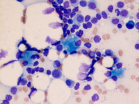 Therapy Related Myeloid Neoplasm 1