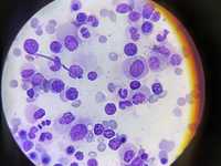 Polycythemia Vera (Bone Marrow Aspirate)