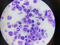 Polycythemia Vera with secondary Iron deficiency