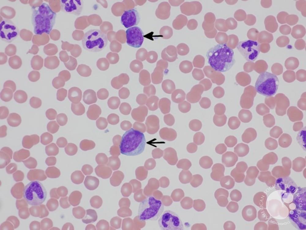 Peripheral blood smear Peripheral blood smear