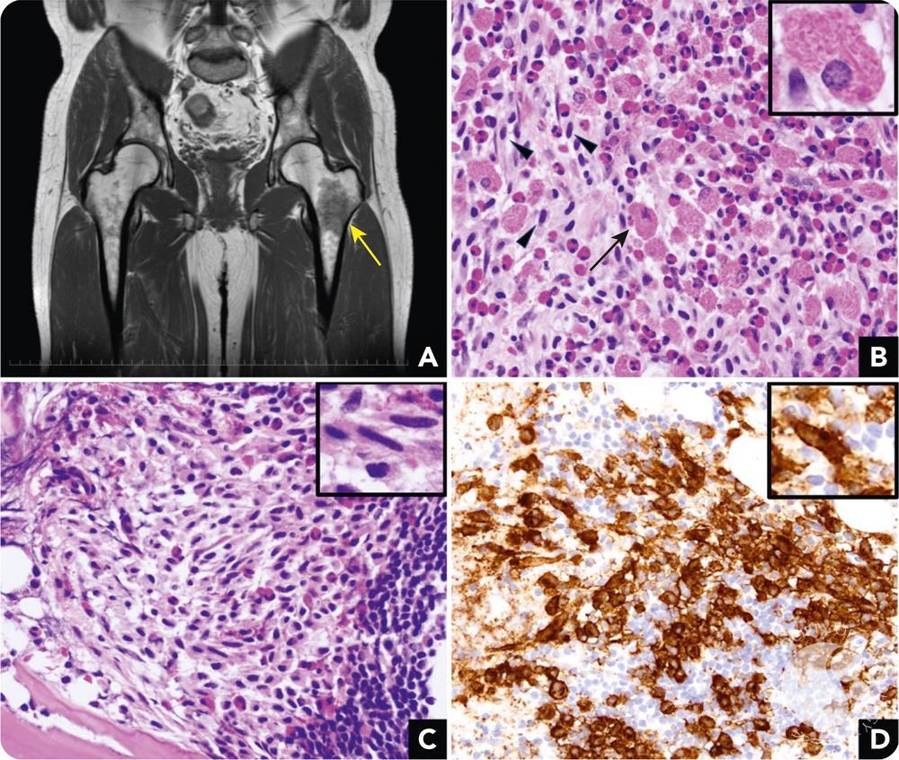 Masqueraded mastocytosis with prominent crystal-storing histiocytic ... Masqueraded mastocytosis with prominent crystal-storing histiocytic ...