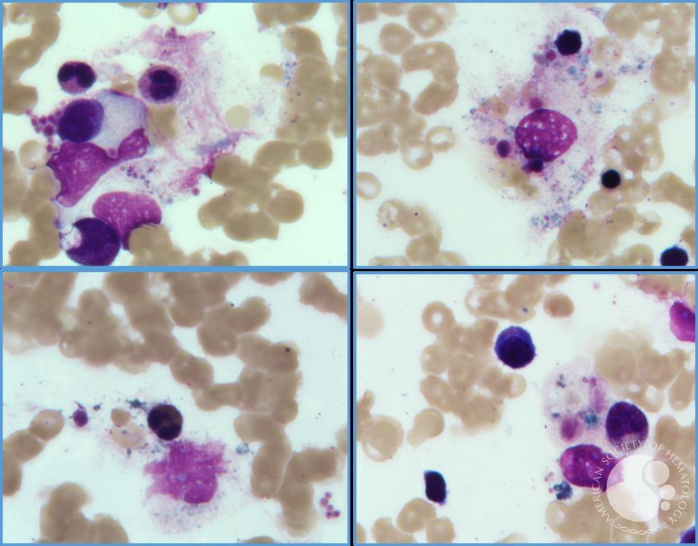 Secondary Hemophagocytic Lymphohistiocytosis Secondary Hemophagocytic Lymphohistiocytosis