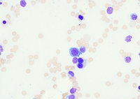 Erythroid Dysplasia 2